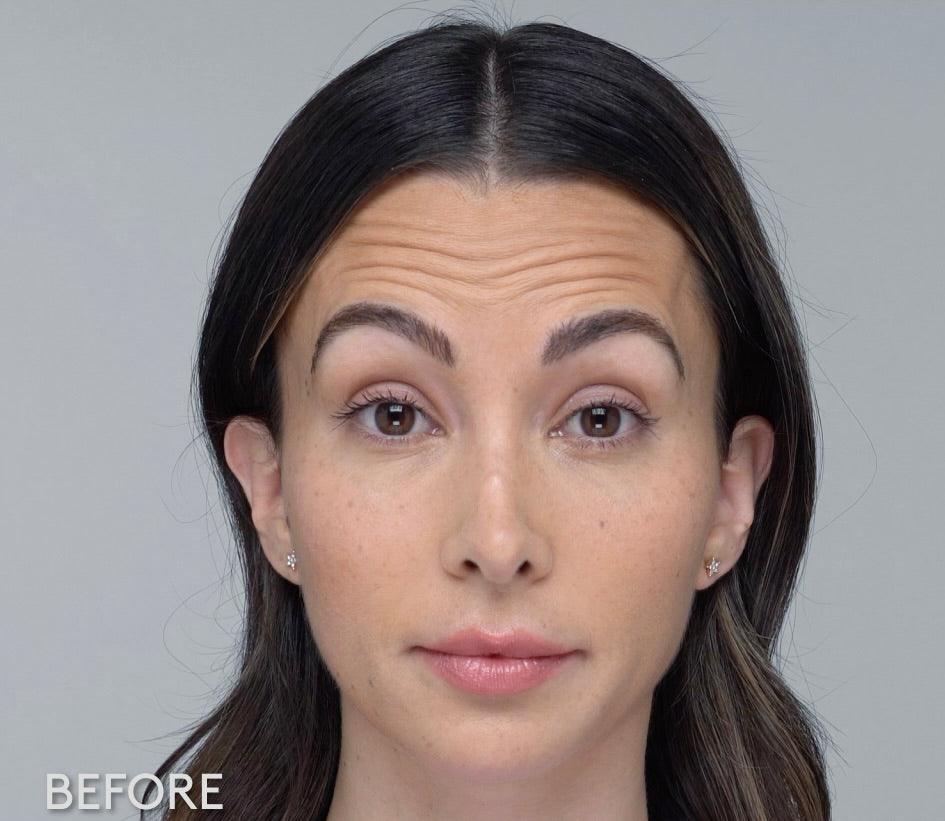 Best Botox Cosmetic in San Francisco | Botox in SF Nob Hill Aesthetics ...