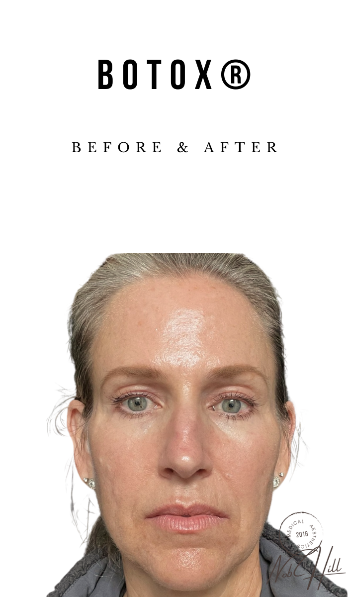 Best Botox Cosmetic in San Francisco | Botox in SF Nob Hill Aesthetics ...